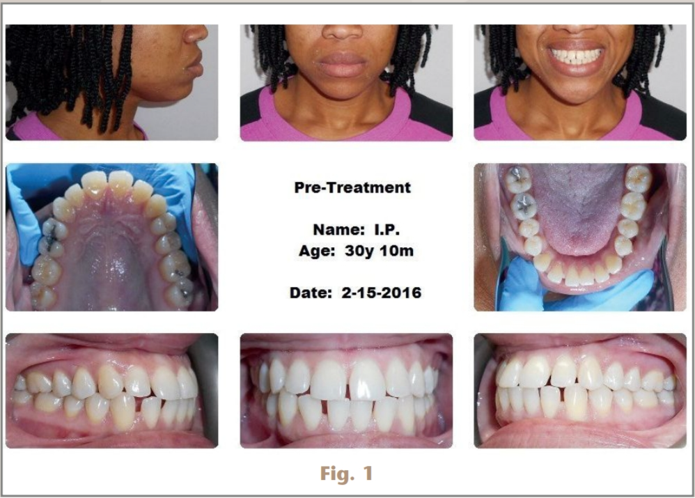 Class III Bimaxillary Protrusion Correction in an Adult Patient - AOS ...
